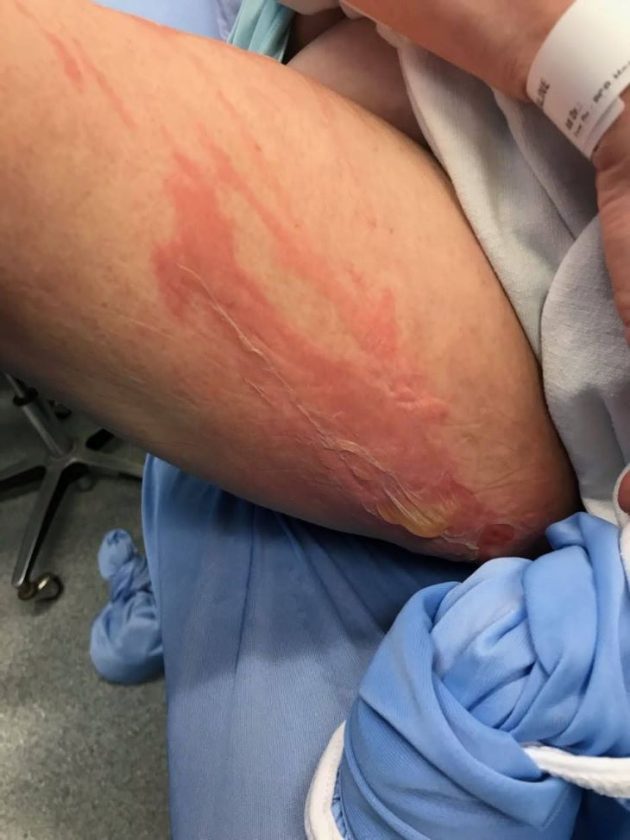 Woman sues Tim Hortons on Hwy 60, says she suffered severe burns due to ...