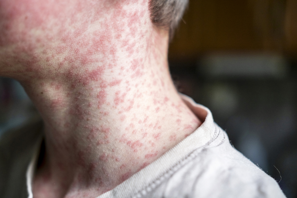 Untangling measles facts from falsehoods to protect your health: Dr ...